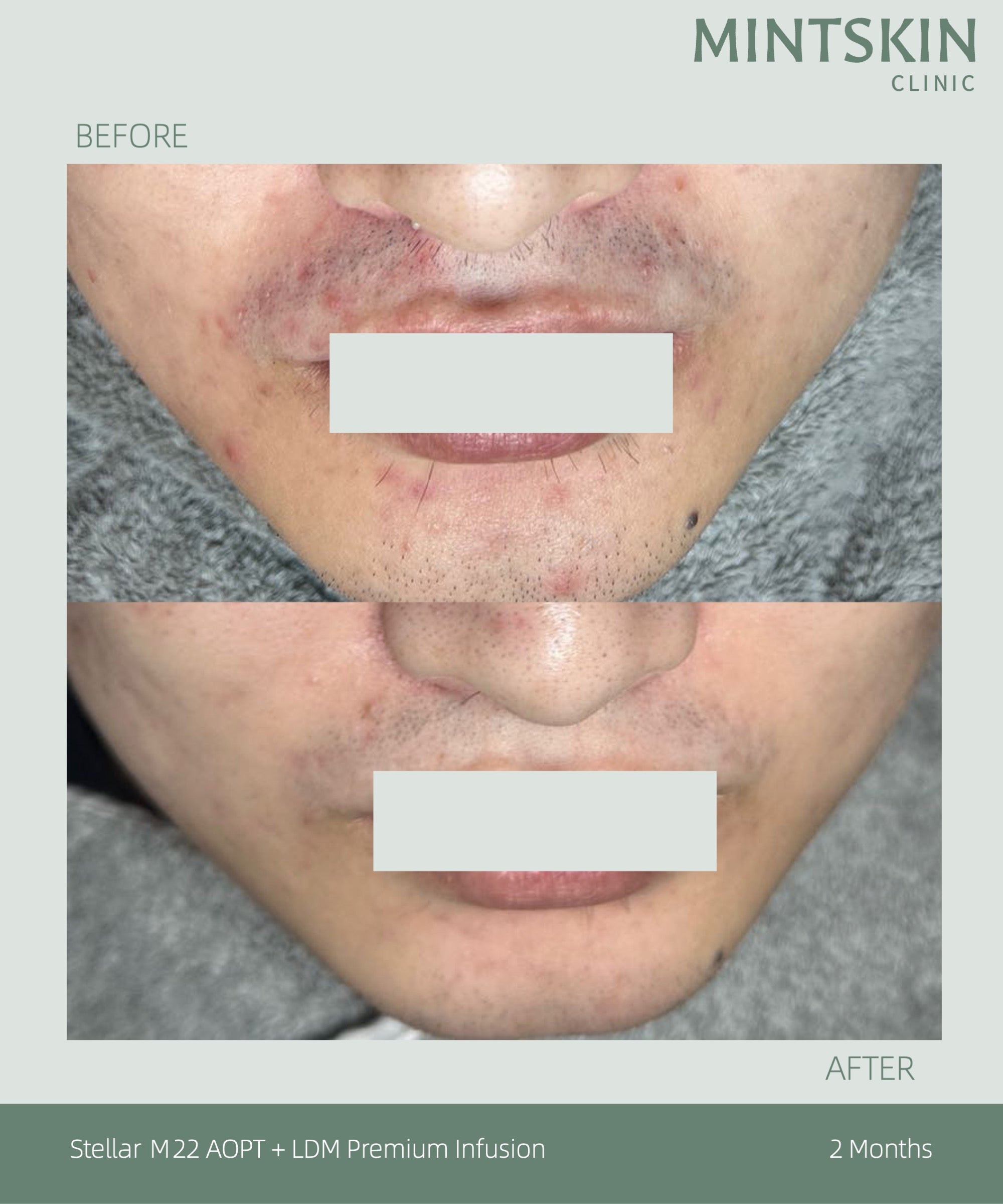 Stellar M22 AOPT 超光子 – MINTSKIN clinic