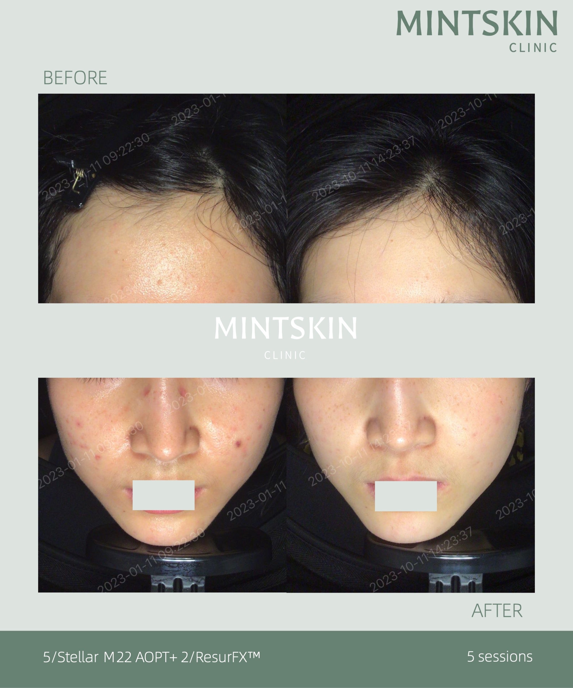 Stellar M22 AOPT 超光子 – MINTSKIN clinic